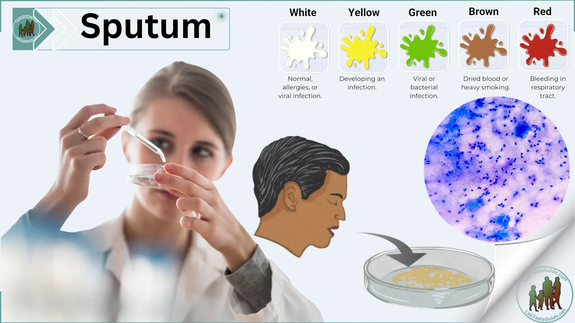 Sputum Defination, Causes, Types and Symptoms | Lab Tests Guide