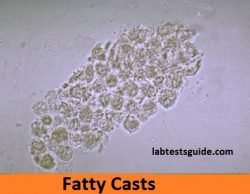 Urinery Casts Types, Results and clinical significations - Lab Tests Guide