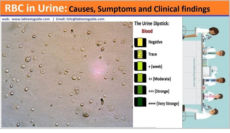 RBC in Urine: Causes and Clinical Significations | Lab Tests Guide