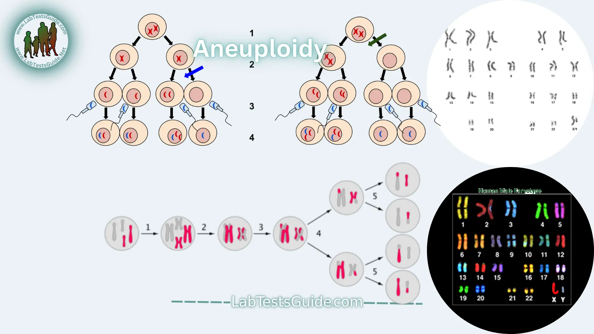 Aneuploidy: Causes, Effects, Diagnosis, and Management