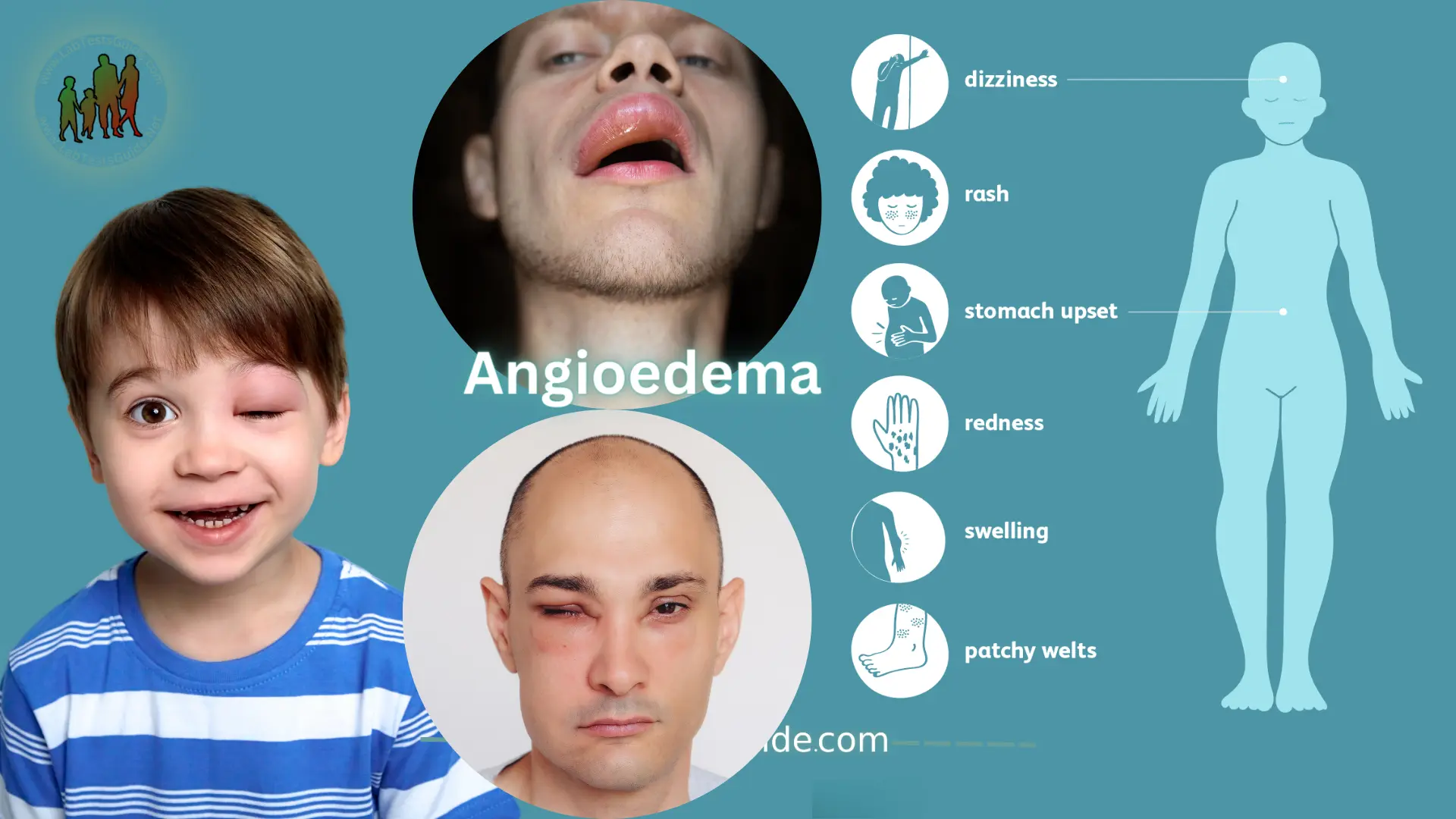 Angioedema: Causes, Symptoms, Treatment, and Prognosis