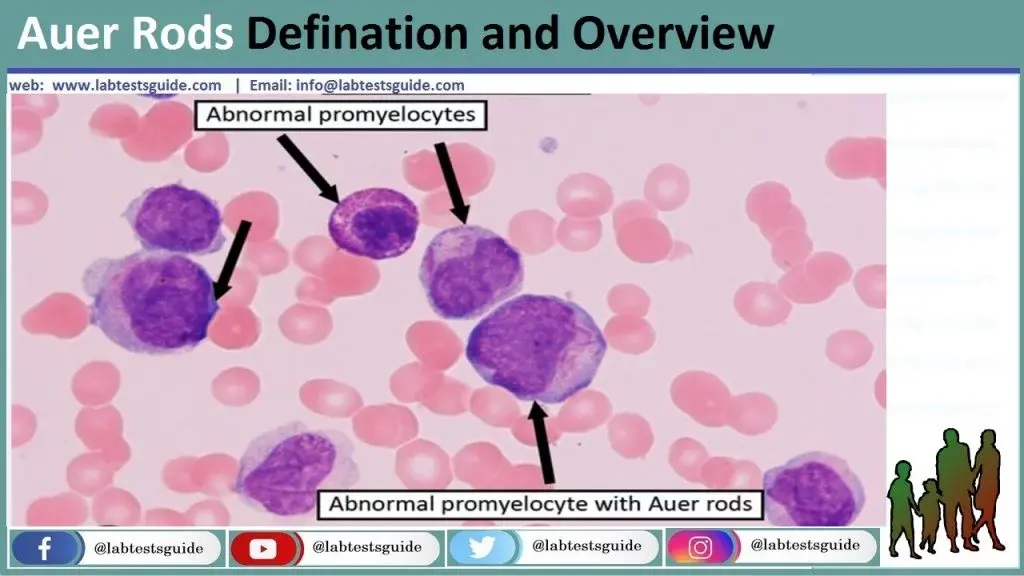 Auer Rods: Characteristics, Significance, and Diagnostic Importance in AML