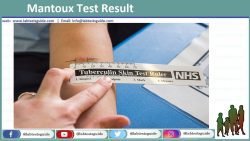 Mantoux Tuberculin Skin Test Porpuse, Procedure, Results | Lab Tests Guide