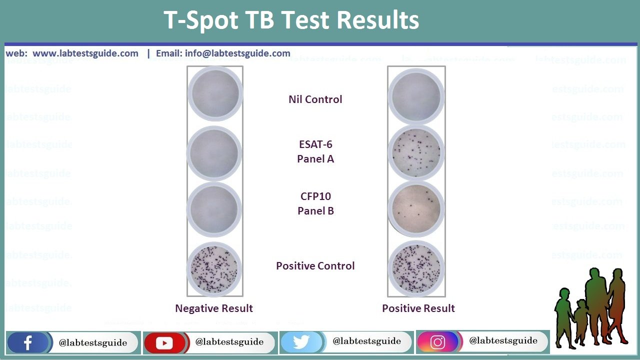 T Spot Test Procedure Results And Interpretation Lab Tests Guide T Spot Test Procedure Results And Interpretation Lab Tests Guide