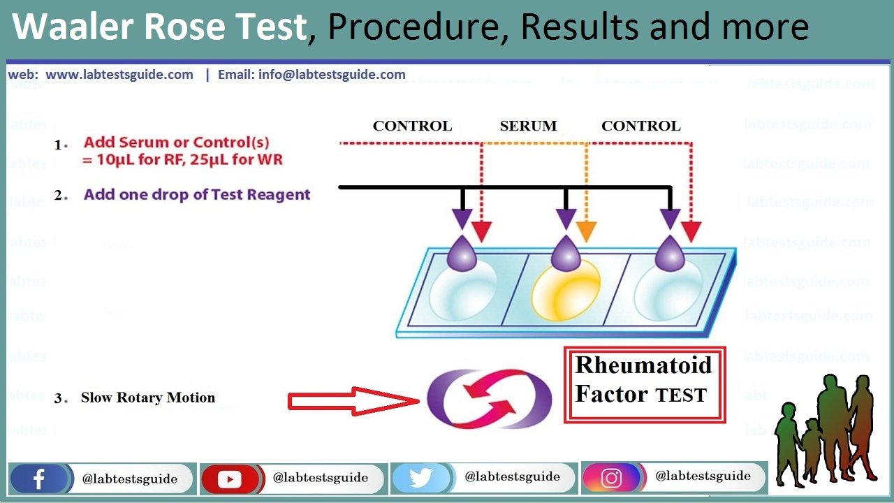 Waaler Rose Test, Procedure, Results and more | Lab Tests Guide