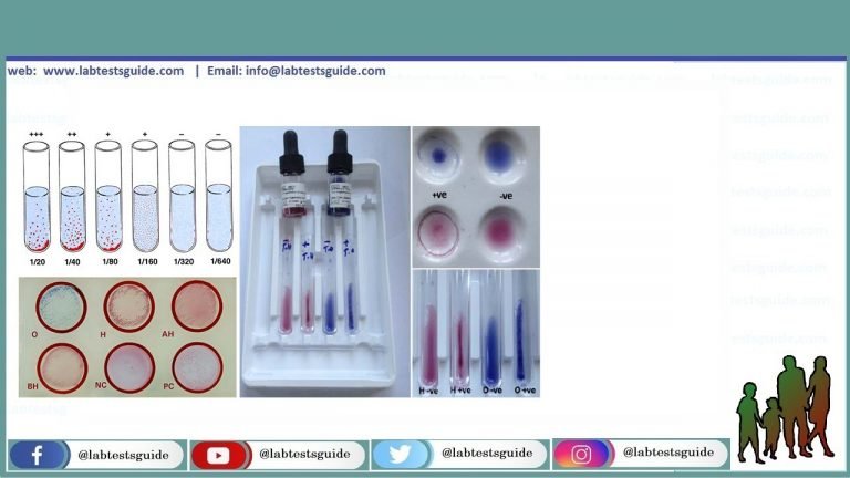 Widal Test Procedure Purpose, Procedure, Reasult and More - Lab Tests Guide