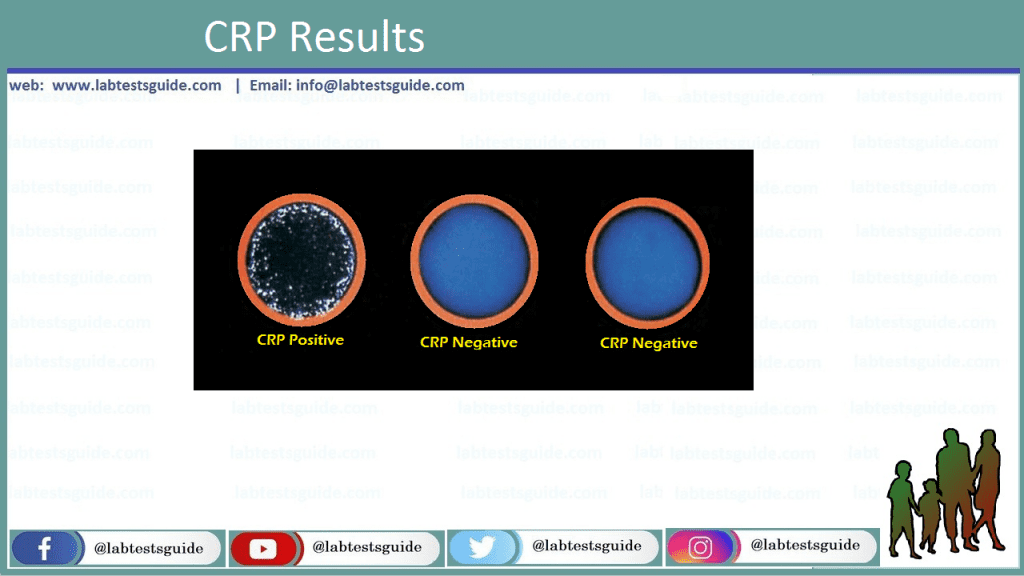 CRP Test Procedure, Result, Method and more | Lab Tests Guide