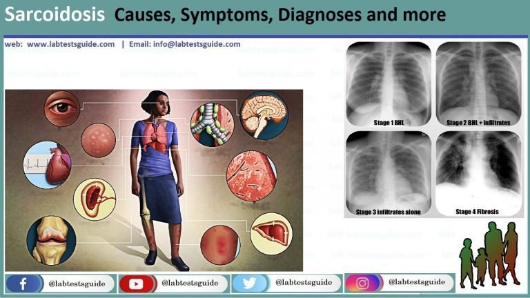 Sarcoidosis Causes, Symptoms, Diagnoses And More | Lab Tests Guide