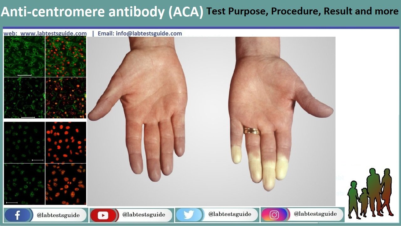 Centromere Antibody Test Purpose, Procedure, Result And More | Lab ...