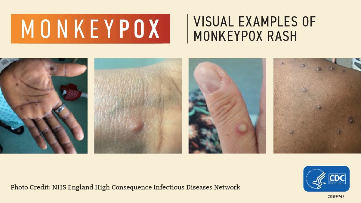 Monkeypox Symptoms, Causes, Prevention and more | Lab Tests Guide