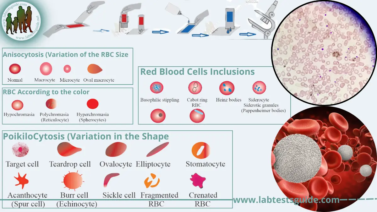 Peripheral Blood Film Test Purpose, Procedure, Result and many more