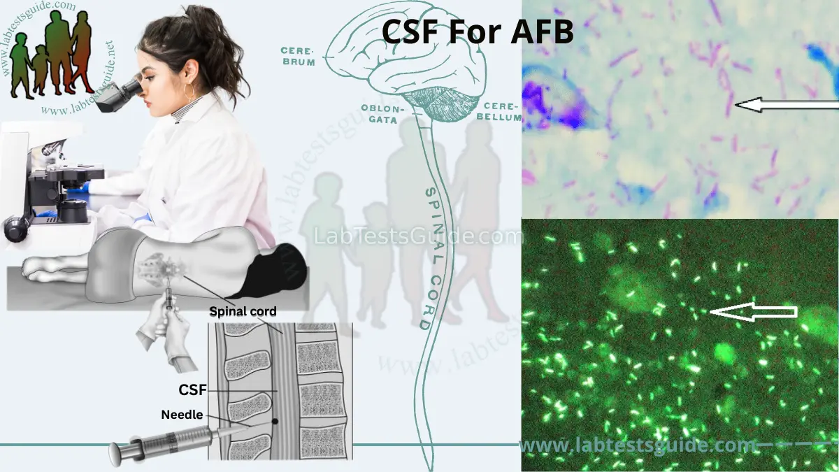 CSF for AFB Test: Purpose, Procedure, Interpretation, and Limitations