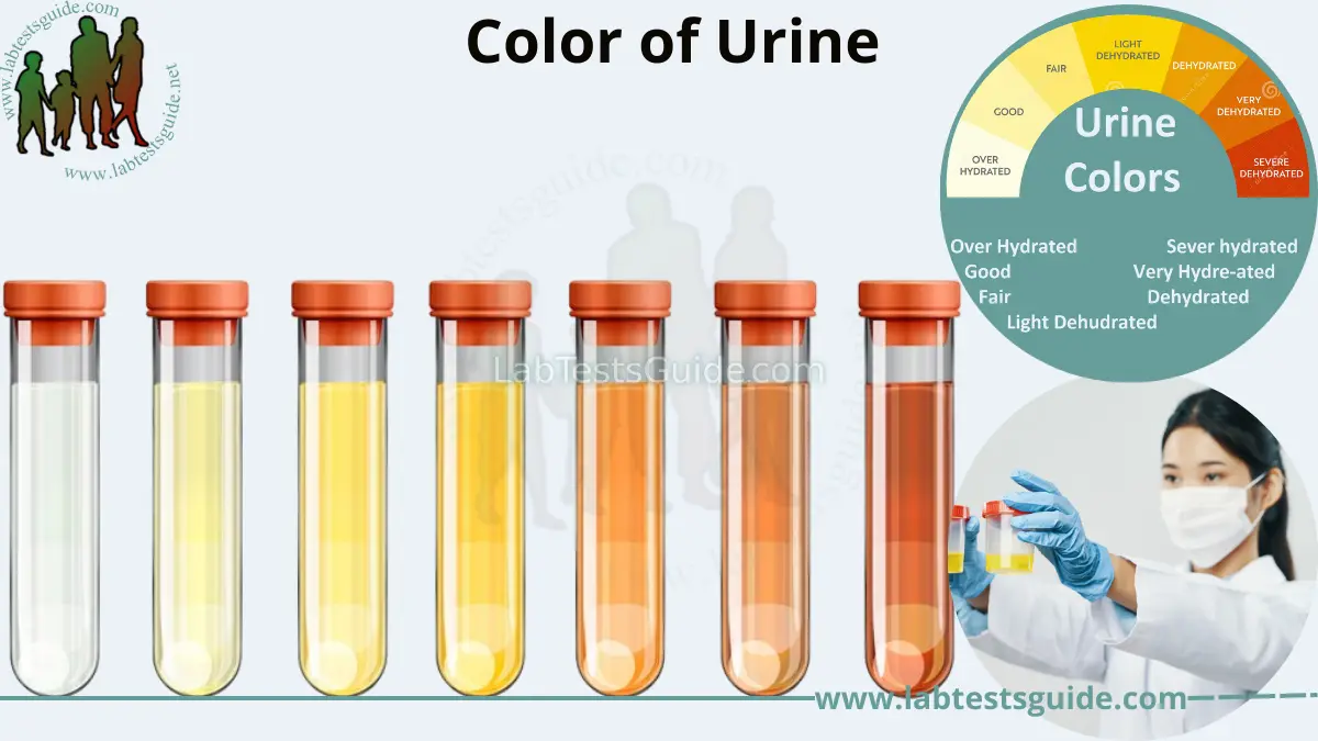 Urine Color, Classifications, Result Interpretations | Lab Tests Guide Urine Color, Classifications, Result Interpretations | Lab Tests Guide