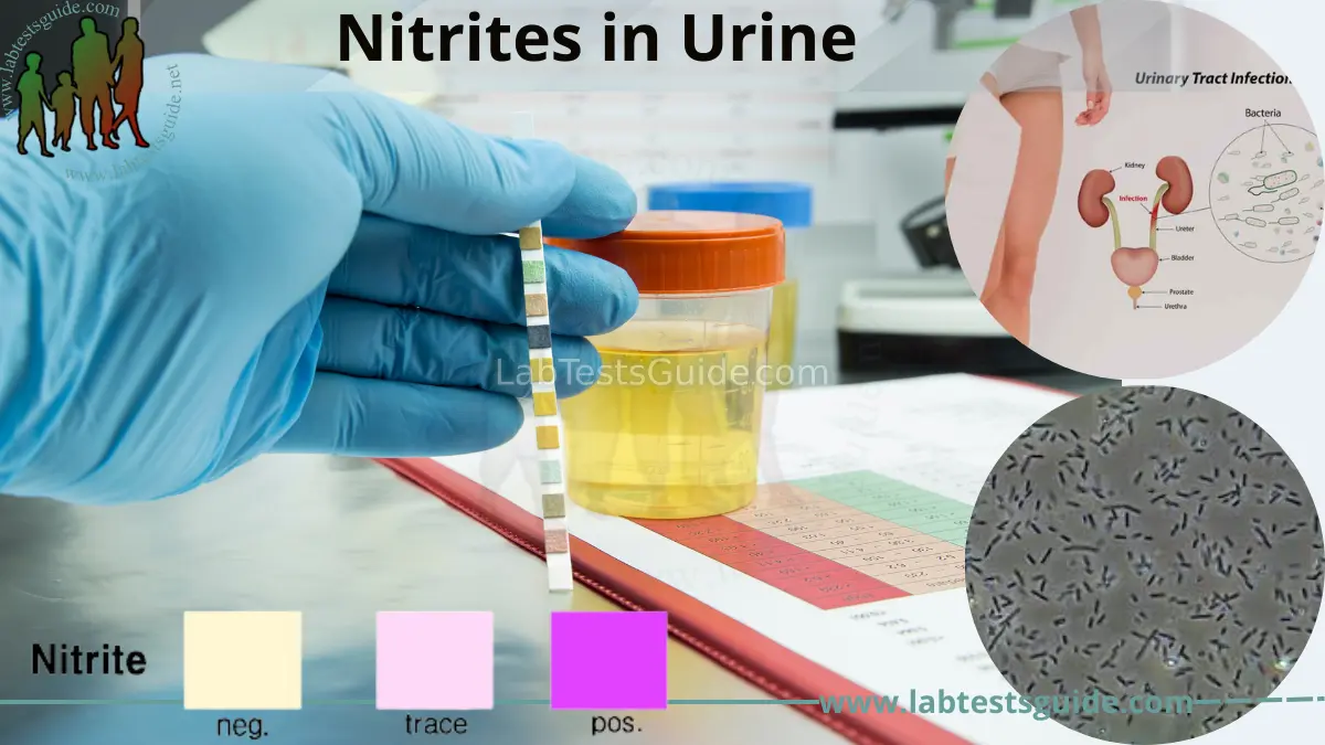 Nitrites in Urine Test: Overview, Procedure, Results Interpretation ...