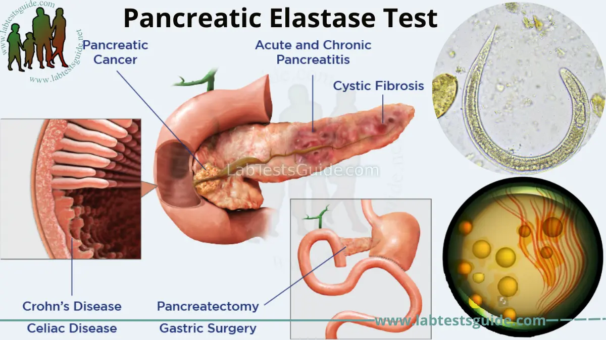 Pancreatic Elastase Test: Purpose, Procedure, and Results - Everything ...