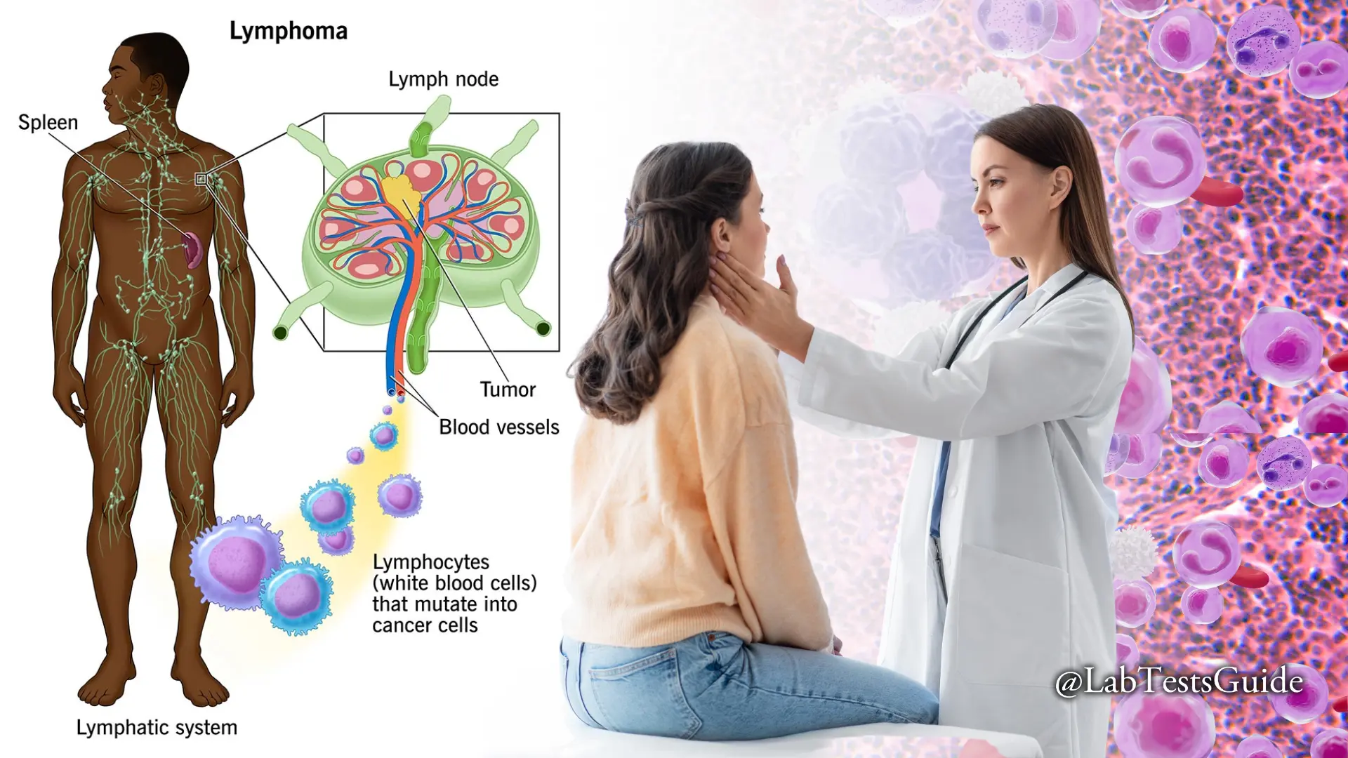 Lymphoma: Types, Causes, Symptoms, Diagnosis, Treatment, and Research