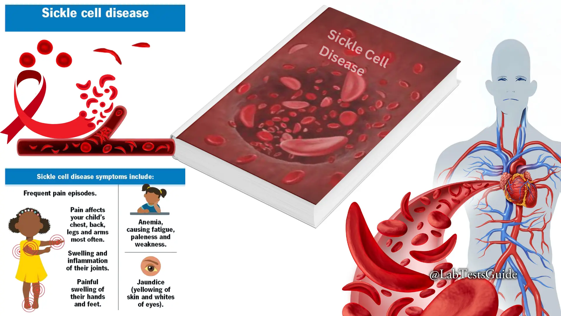 Sickle Cell Disease Symptoms, Causes, Diagnosis, Treatement and Preventions