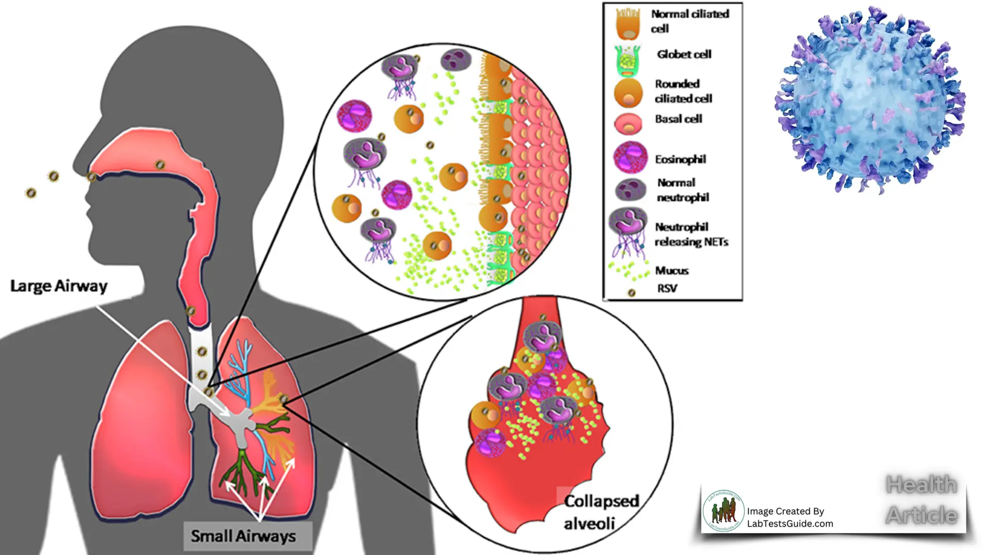 RSV Awareness: Essential Information and Preventive Measures for High ...