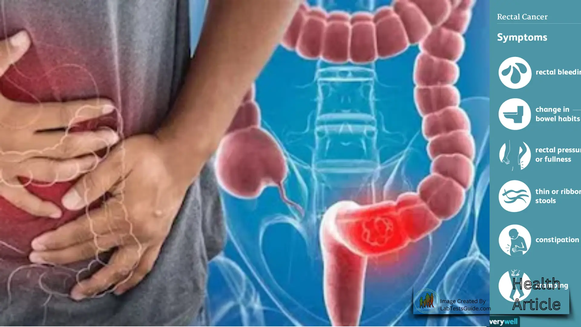 The Subtle Signs of Bowel Cancer: Four Key Symptoms to Watch Out For ...